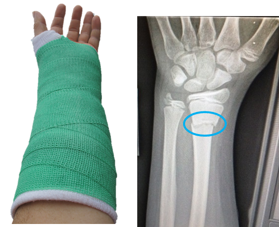 How a wrist guard might have saved Katie Ormerod’s wrist in Pyeongchang ...